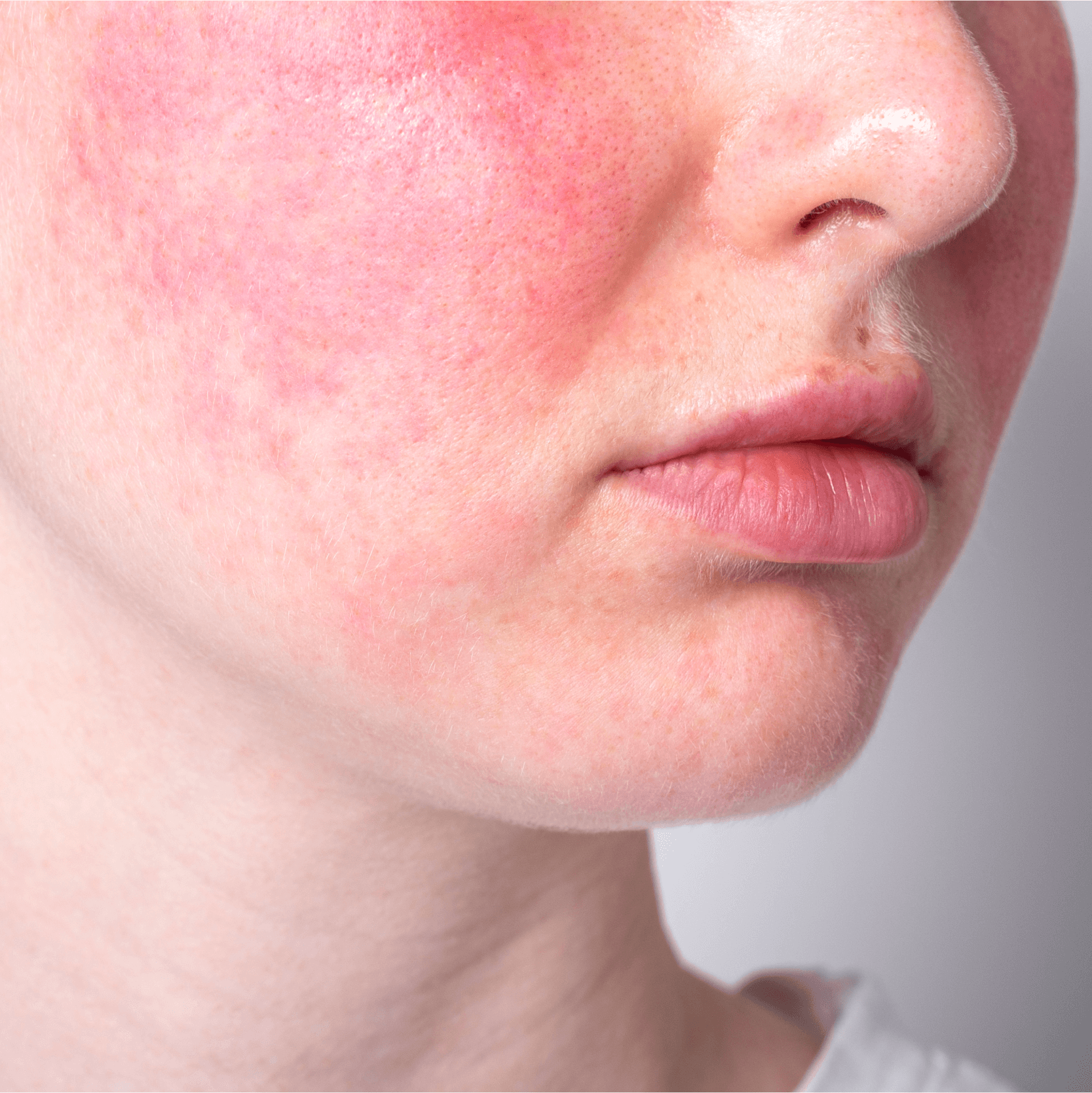 Inflammation / Redness – Induction Therapies